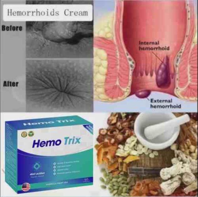 Can a haemorrhoid cream Hemo Trix cure haemorrhoids?