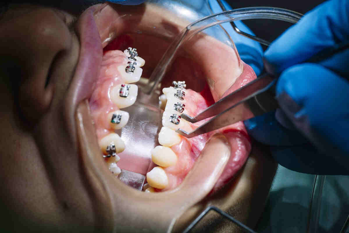 How are dental braces fixed?