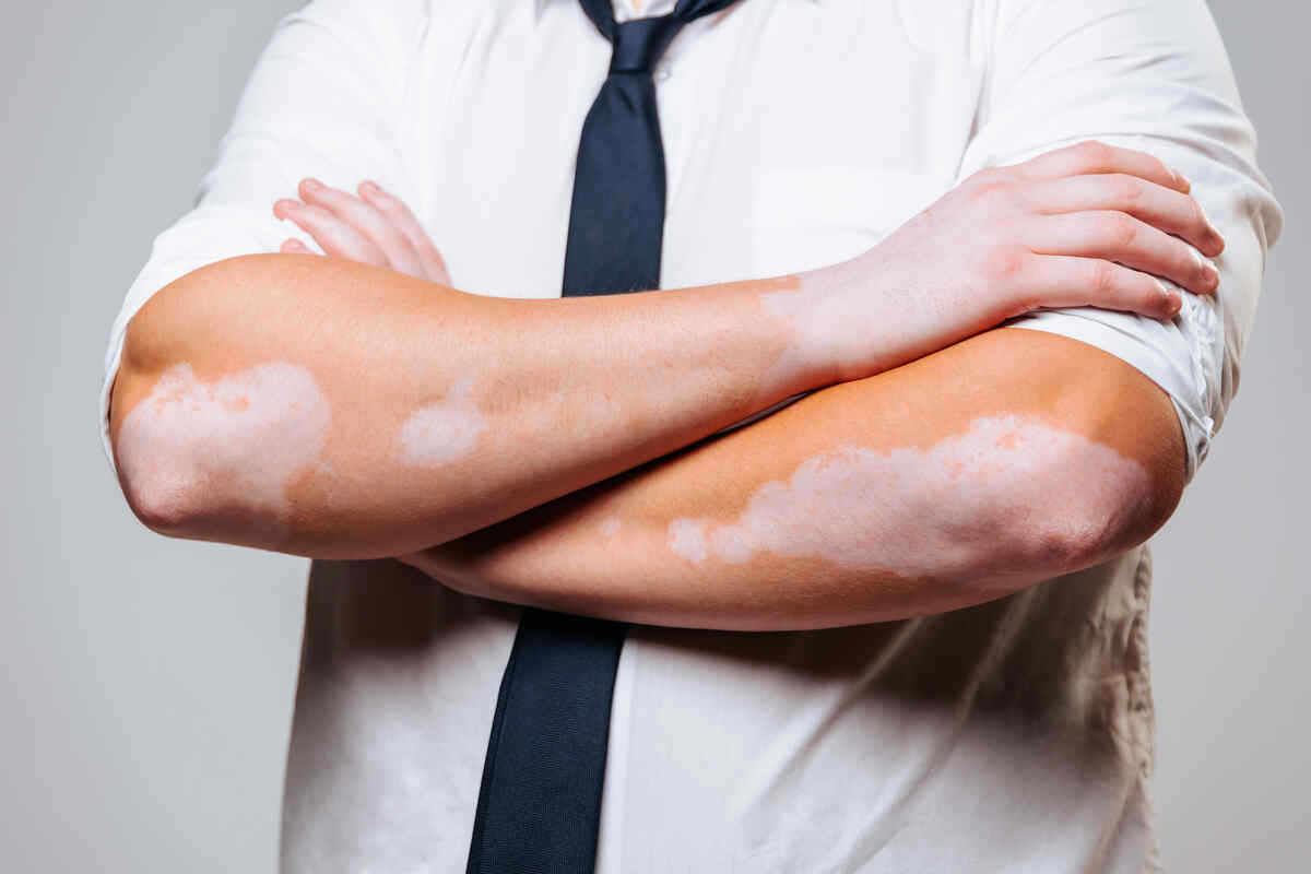What is Vitiligo?