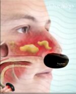 Fact Check: Can a red light therapy cure sinusitis?