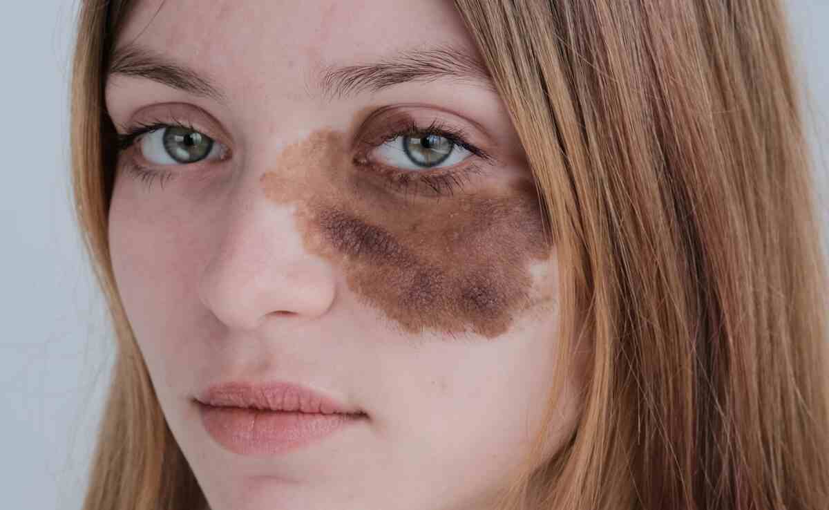 Birthmarks on Body: What parents should know - THIP Media